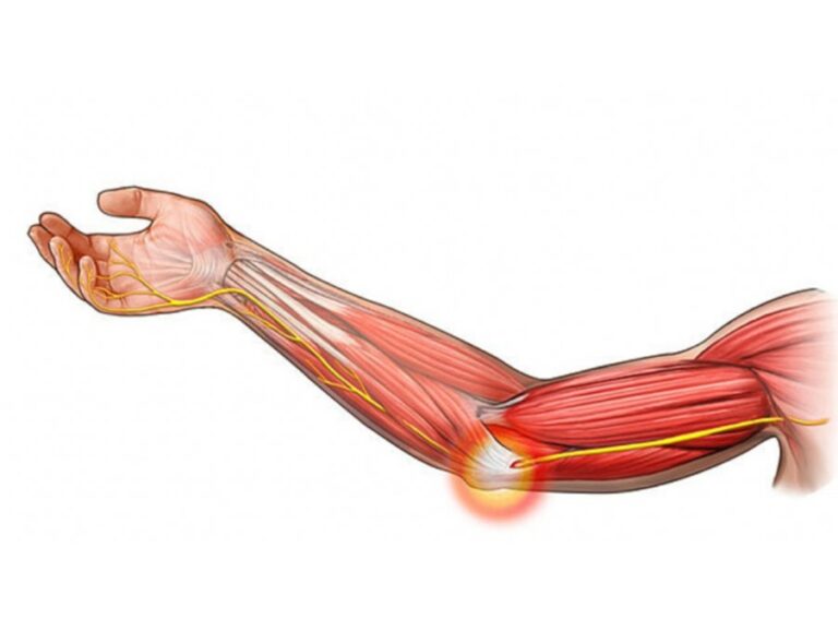 La compression du nerf ulnaire au coude – Rennes Ortho Sport